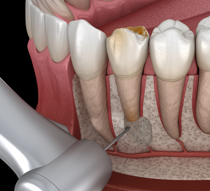 Chirurginės procedūros | Irmadent | Privati odontologijos ir estetikos ...