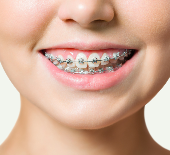 Orthodontic Treatment | Irmadent | Private dental & aesthetic clinic