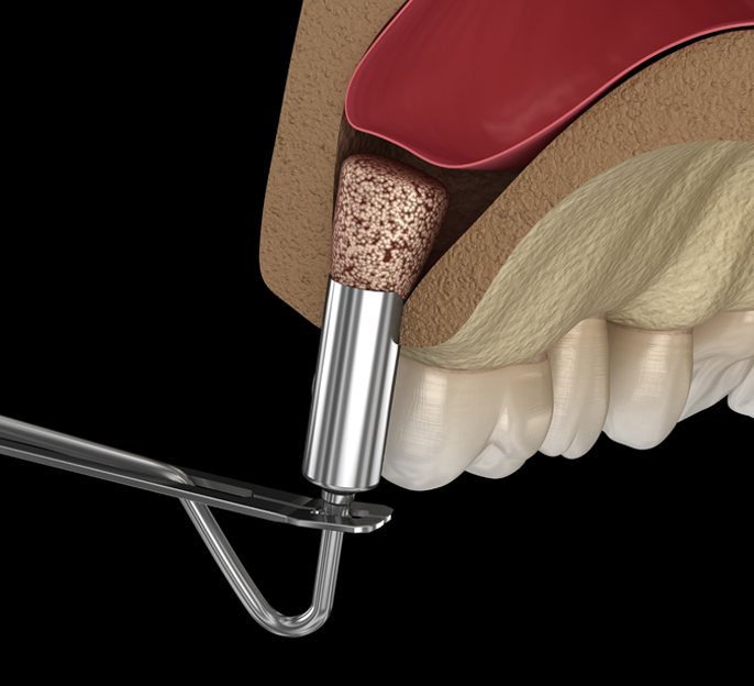 Implant Dentistry | Irmadent | Private dental & aesthetic clinic