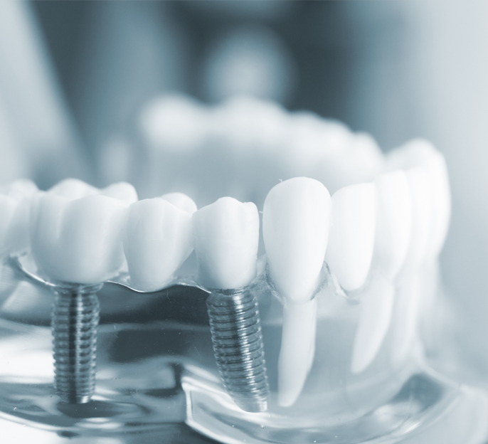 Implant Dentistry | Irmadent | Private dental & aesthetic clinic